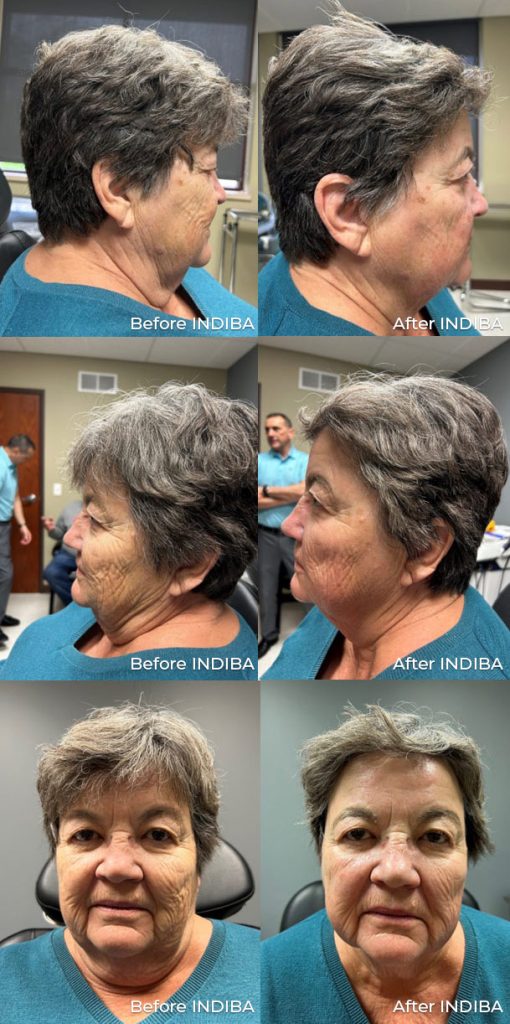 INDIBA available at MediJUV located in Cedar Rapids, IA